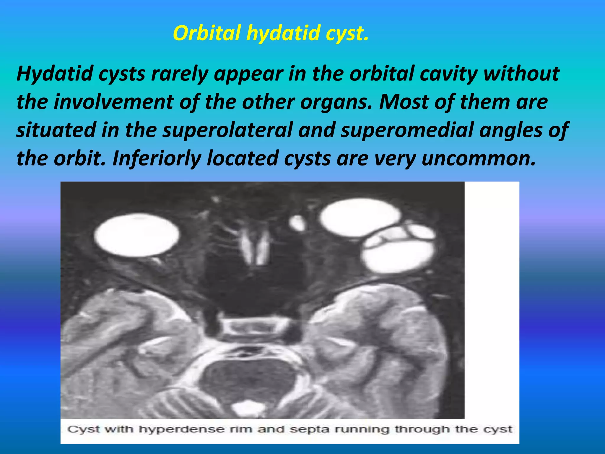 Presentation1.pptx. hydatid disease. | PPTX