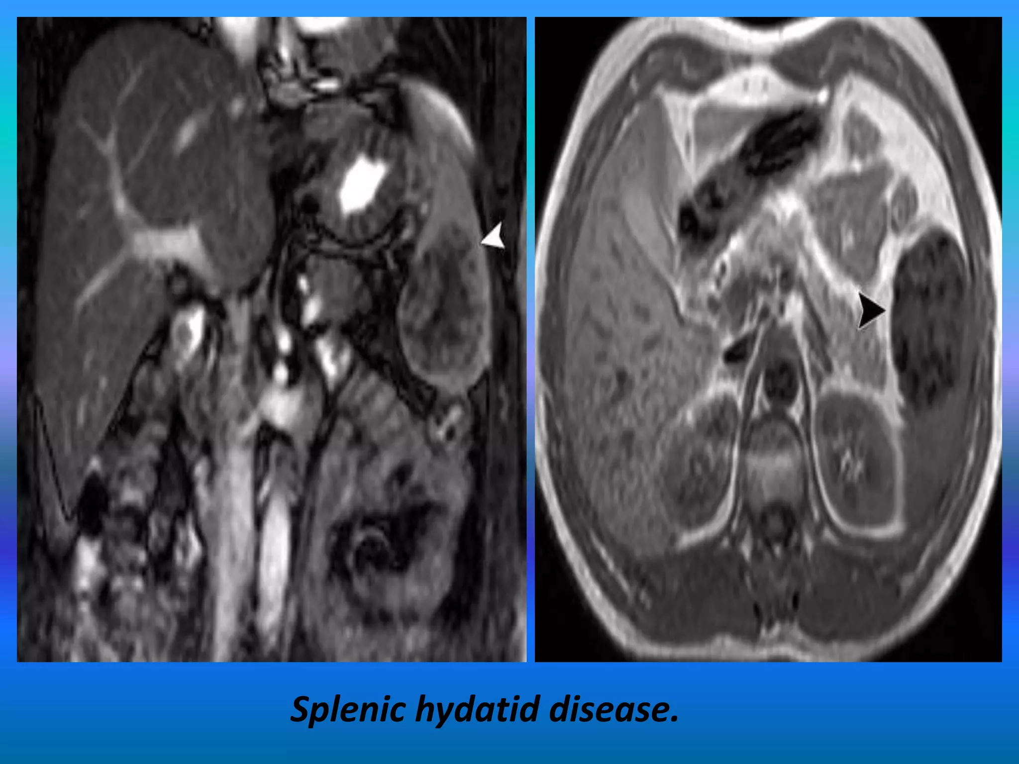 Presentation1.pptx. hydatid disease. | PPTX