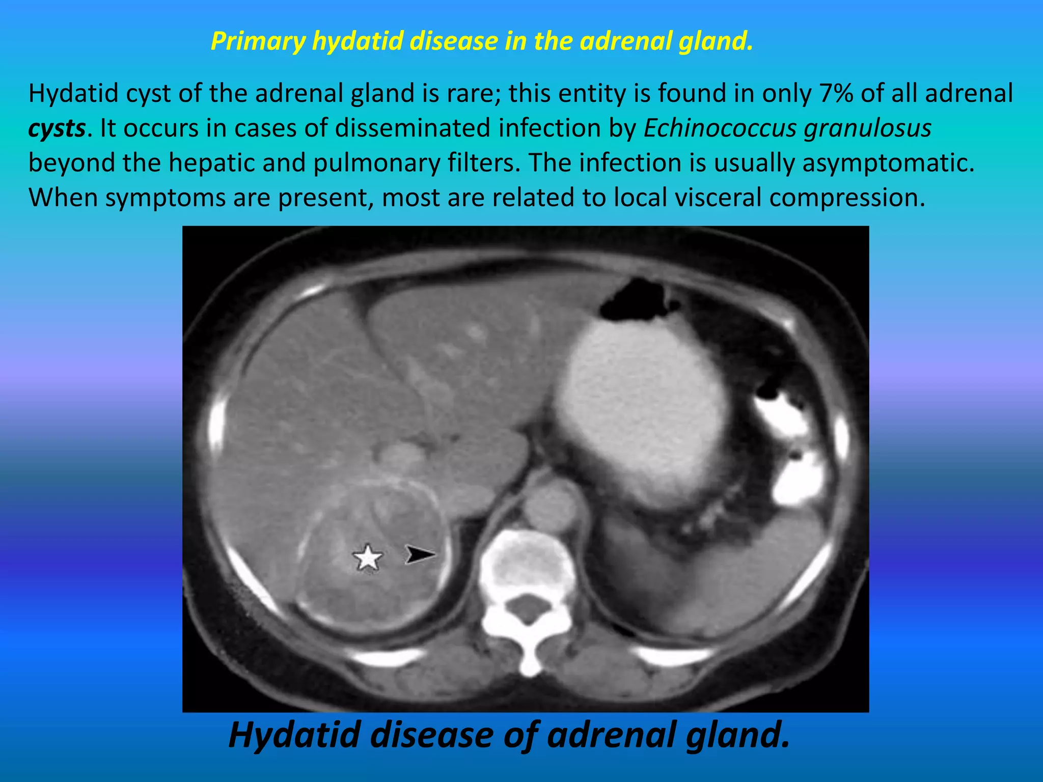 Presentation1.pptx. hydatid disease. | PPT