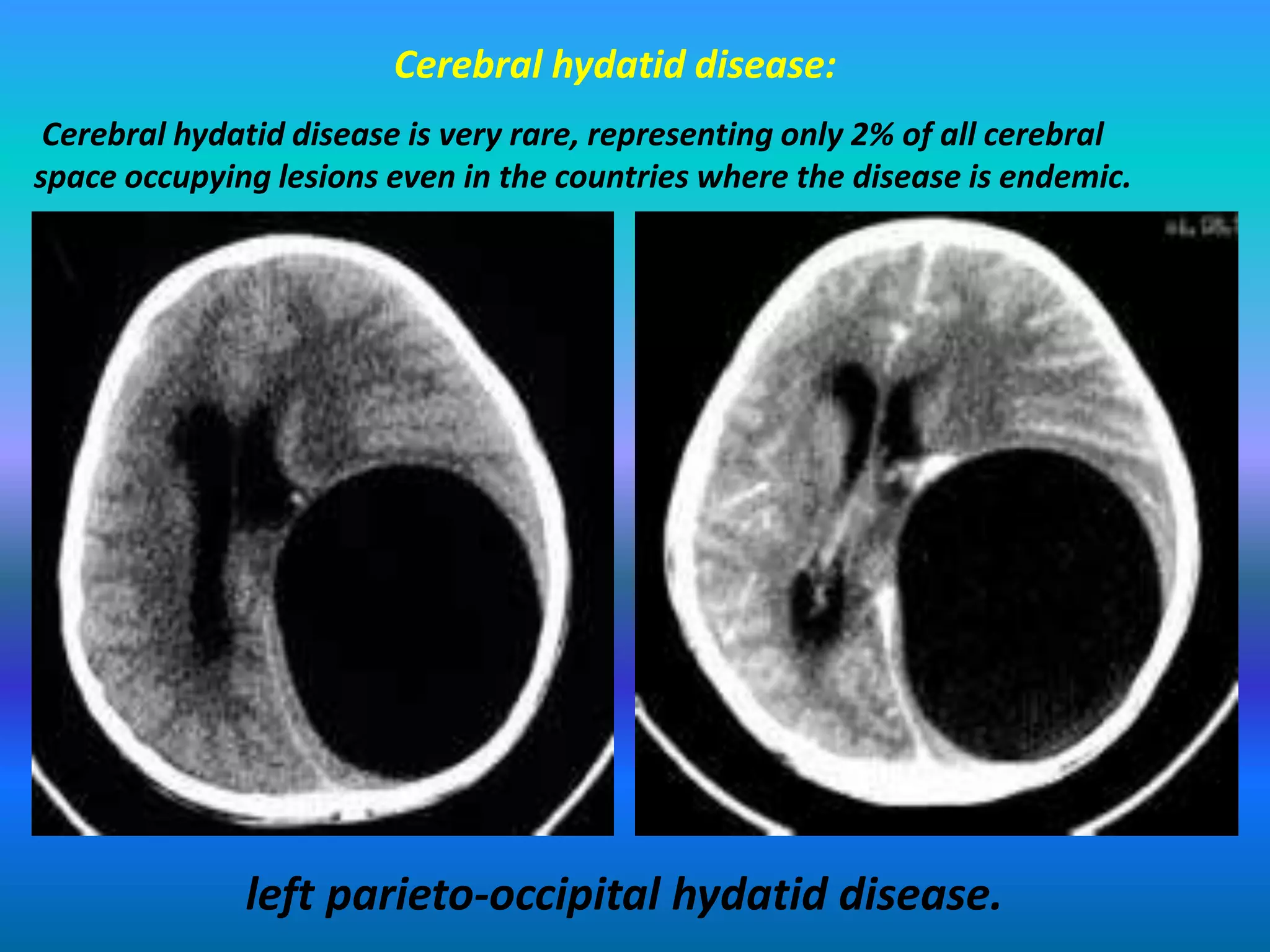 Presentation1.pptx. hydatid disease. | PPTX