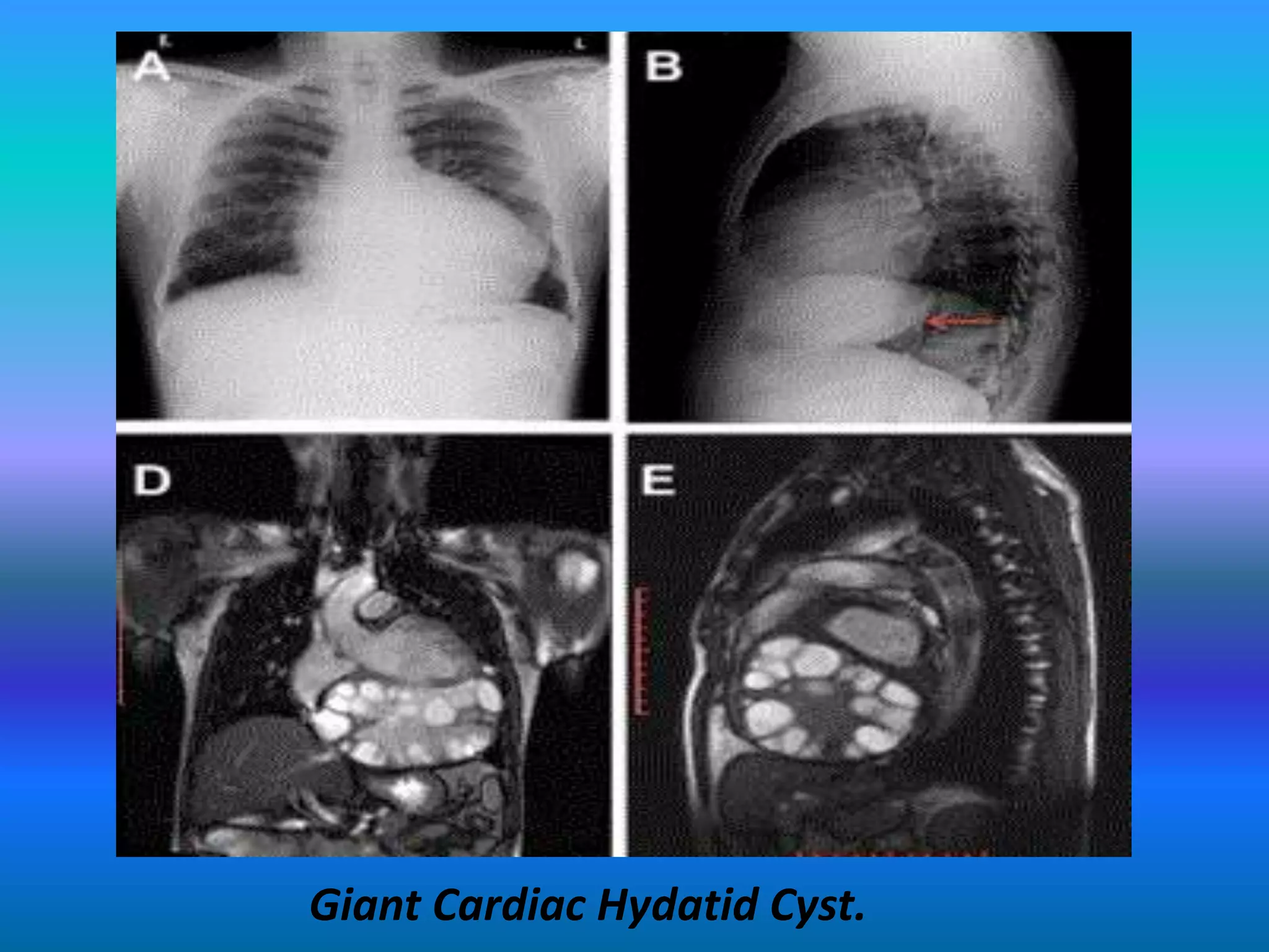 Presentation1.pptx. hydatid disease. | PPTX