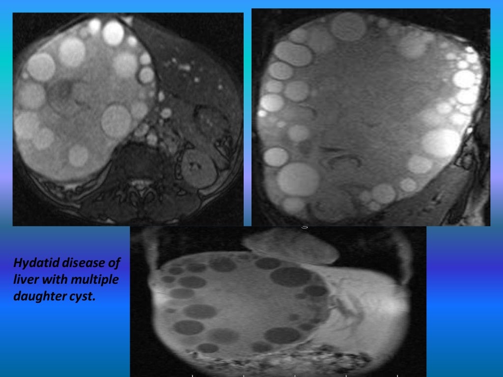 Presentation1.pptx. hydatid disease.