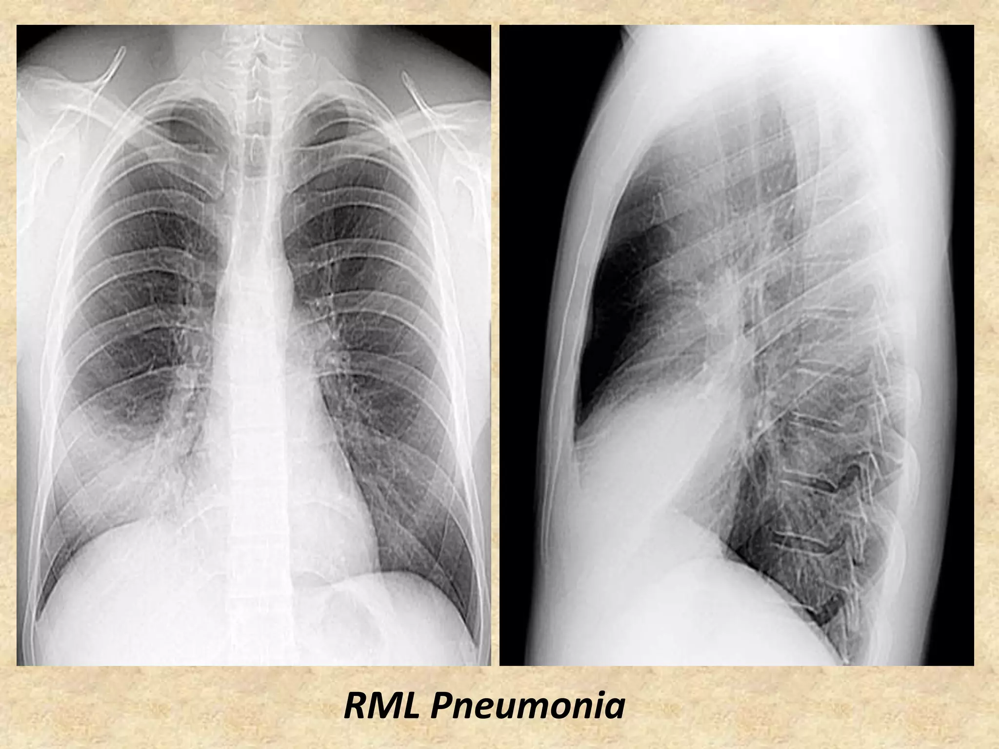 Presentation1.pptx, radiological imaging of pulmonary infection. | PPTX
