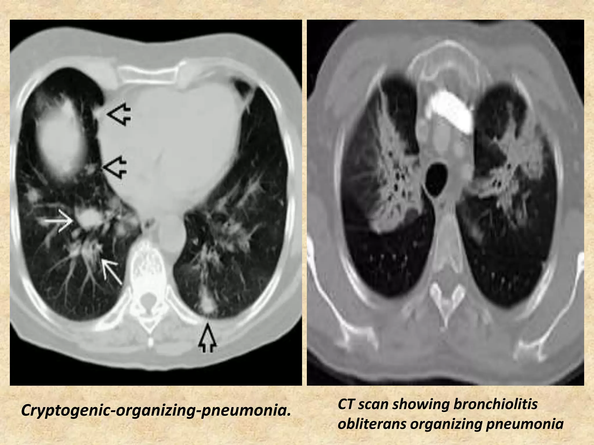 Presentation1.pptx, radiological imaging of pulmonary infection. | PPTX