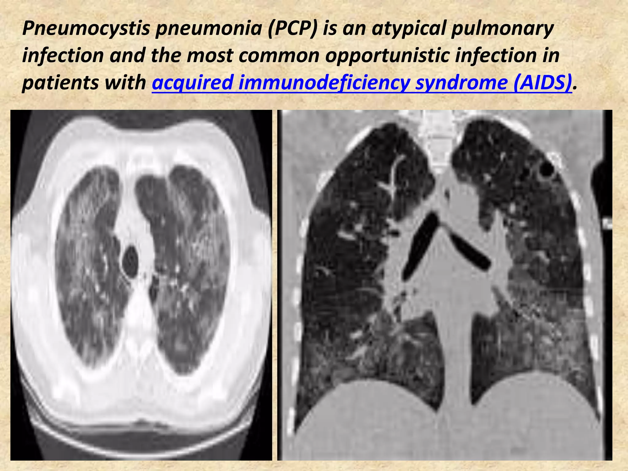 Presentation1.pptx, radiological imaging of pulmonary infection. | PPTX