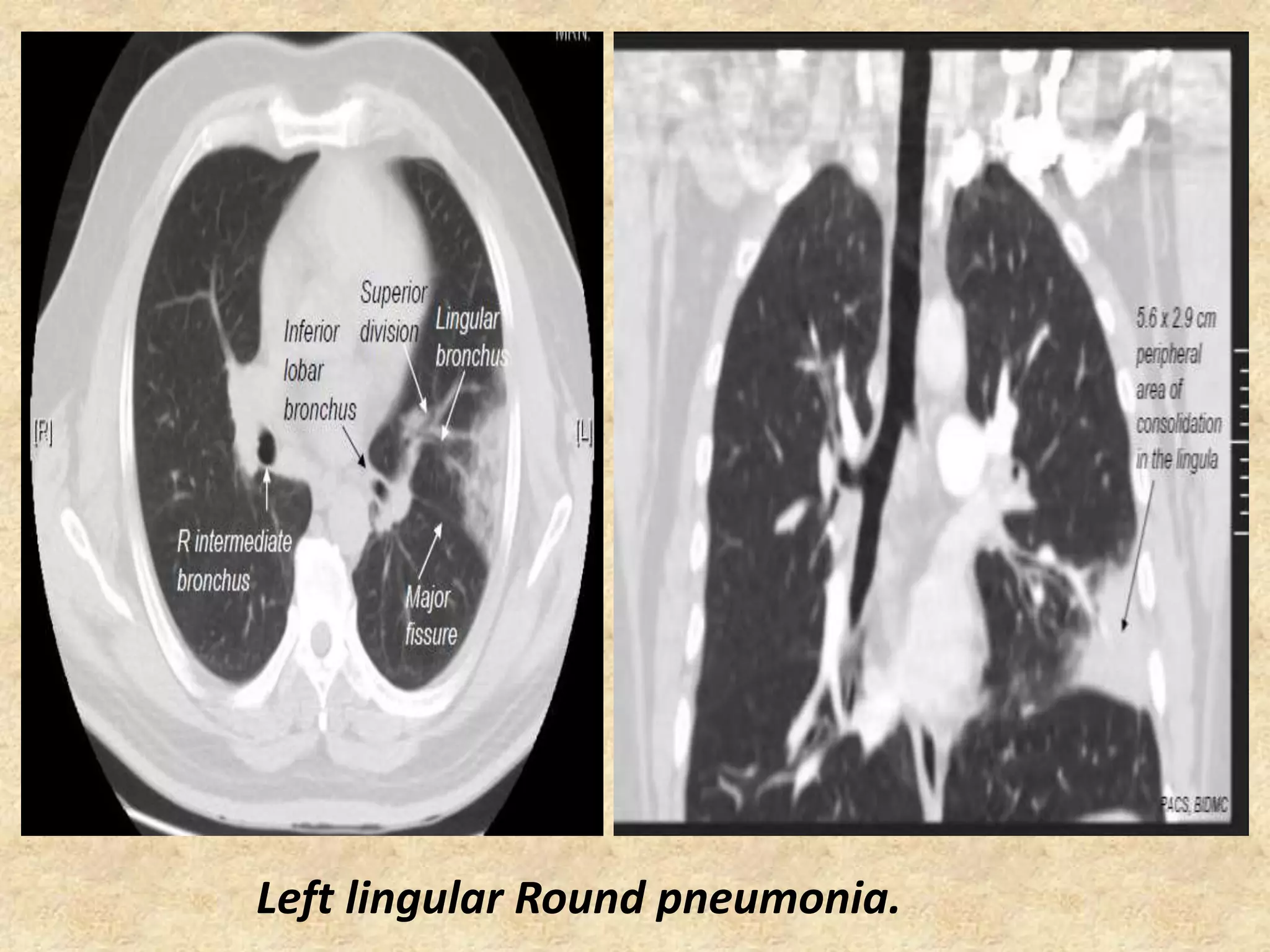 Presentation1.pptx, radiological imaging of pulmonary infection. | PPTX