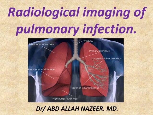 Presentation1.pptx, radiological imaging of pulmonary infection. | PPTX ...