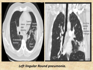Presentation1.pptx, radiological imaging of pulmonary infection. | PPTX