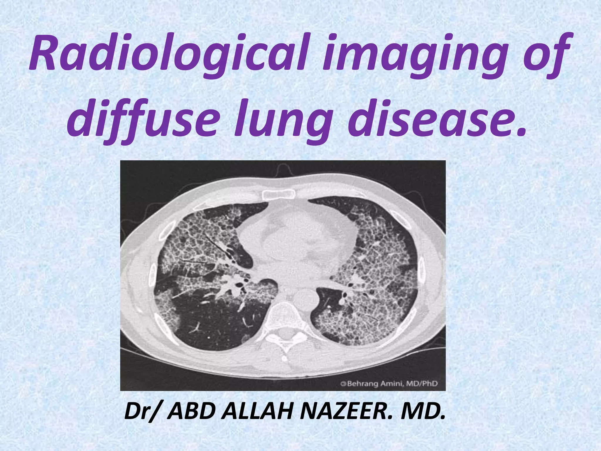 Presentation1.pptx, radiological imaging of diffuse lung disease. | PPTX