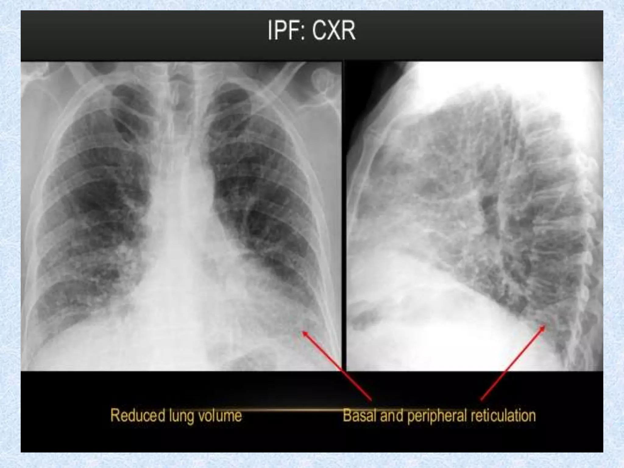 Presentation1.pptx, radiological imaging of diffuse lung disease. | PPTX