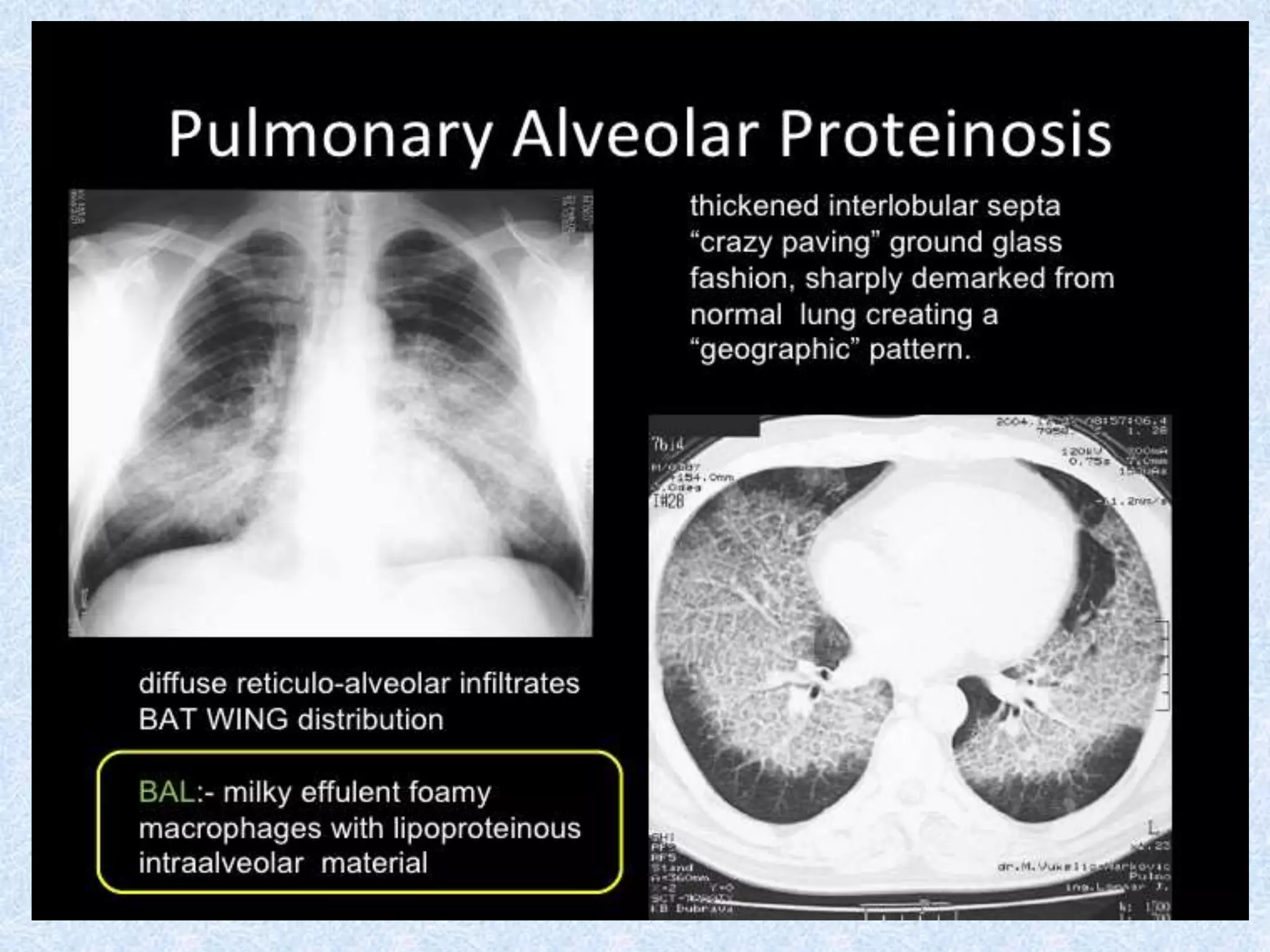 Presentation1.pptx, radiological imaging of diffuse lung disease. | PPTX