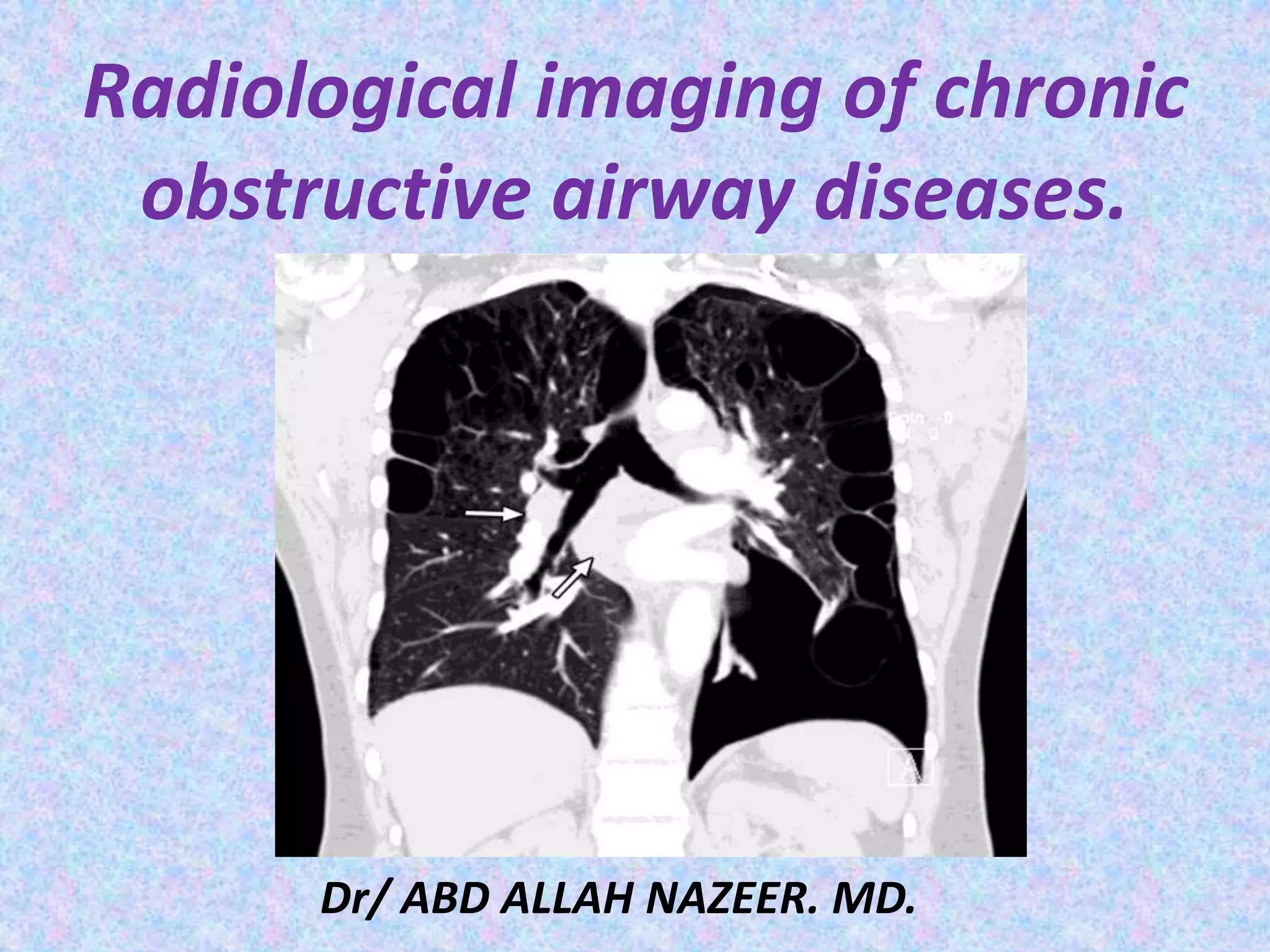 Presentation1.pptx, radiological imaging of copd. | PPTX