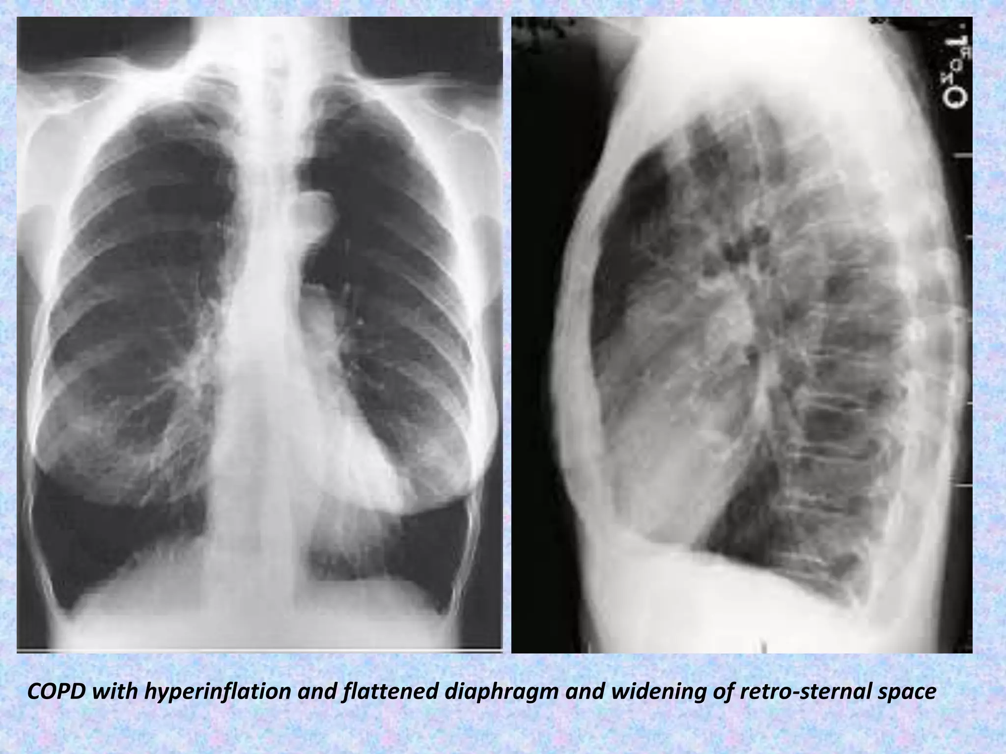 Presentation1.pptx, radiological imaging of copd. | PPTX
