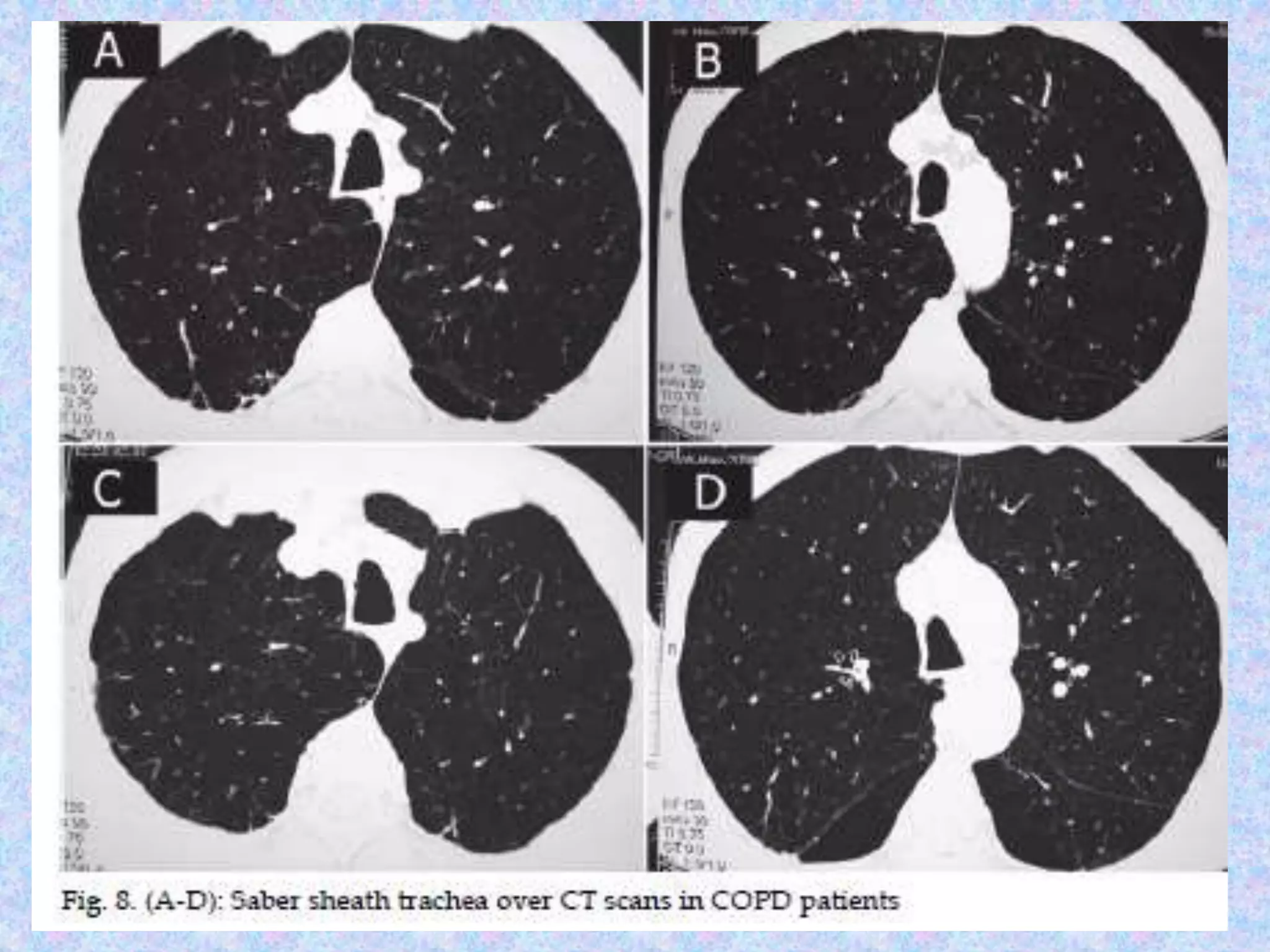 Presentation1.pptx, radiological imaging of copd. | PPTX