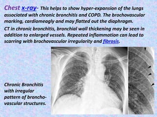 Chest X Ray Emphysema Findings