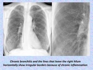 Chronic Bronchitis X Ray