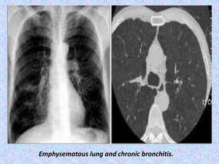 Copd Ct Scan Findings
