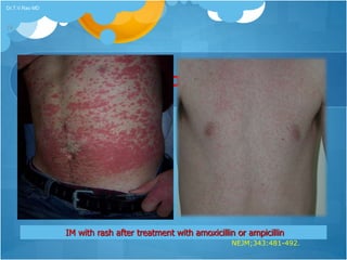 Epstein-Barr Virus | PPTX