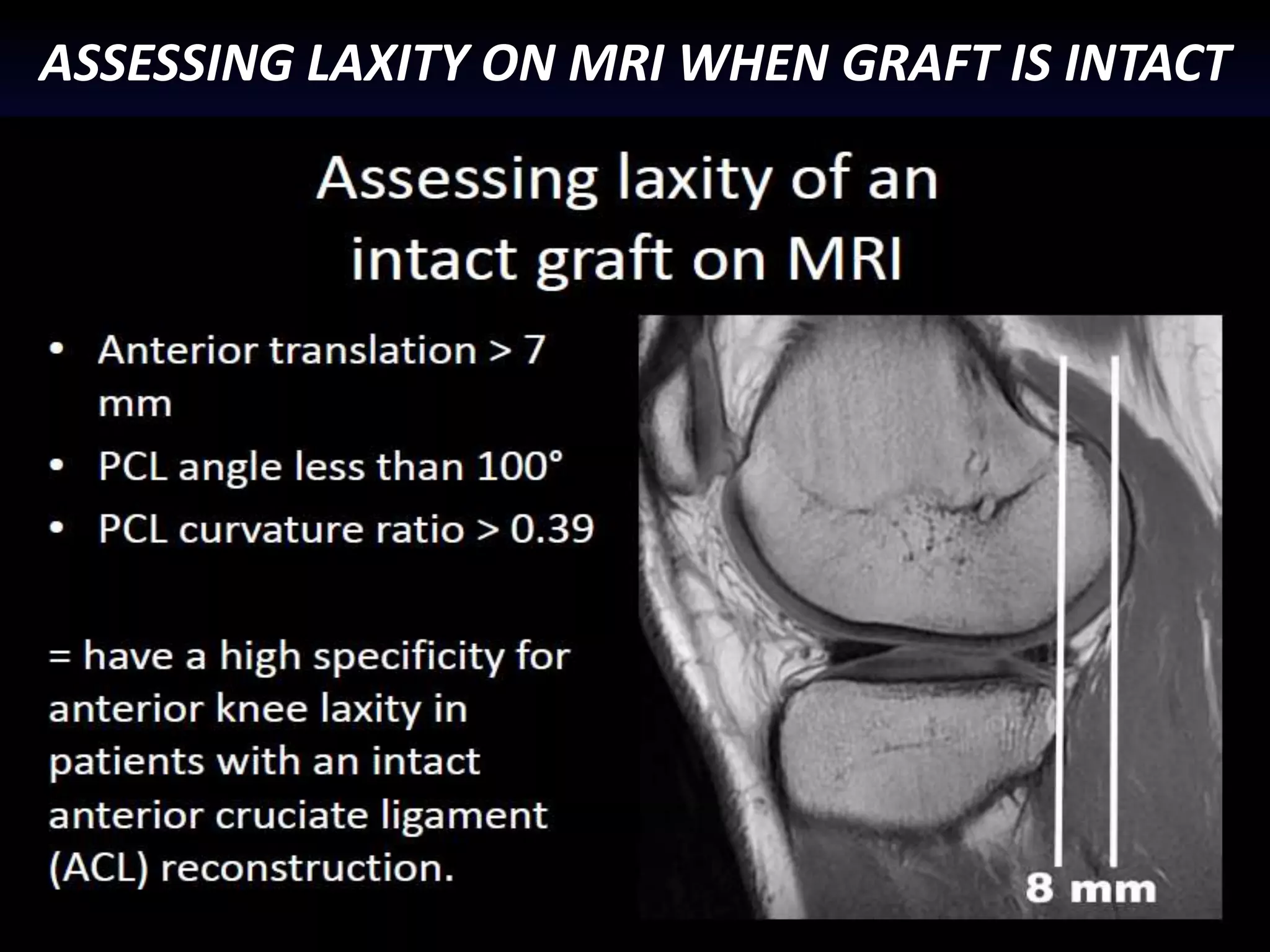 Presentation1.pptx, radiological assessment of acl graft. | PPTX