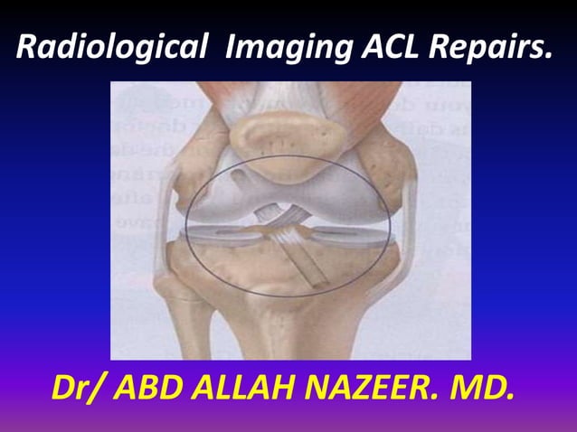 Presentation1.pptx, radiological assessment of acl graft. | PPTX