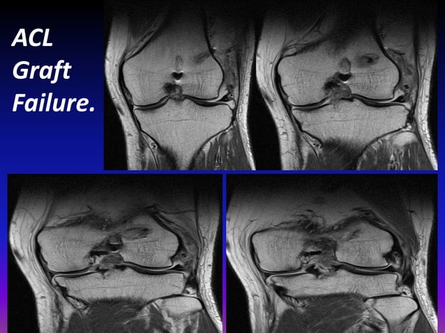 Presentation1.pptx, radiological assessment of acl graft. | PPTX ...