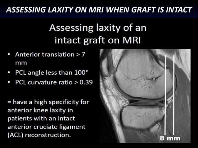 Presentation1.pptx, radiological assessment of acl graft. | PPTX ...