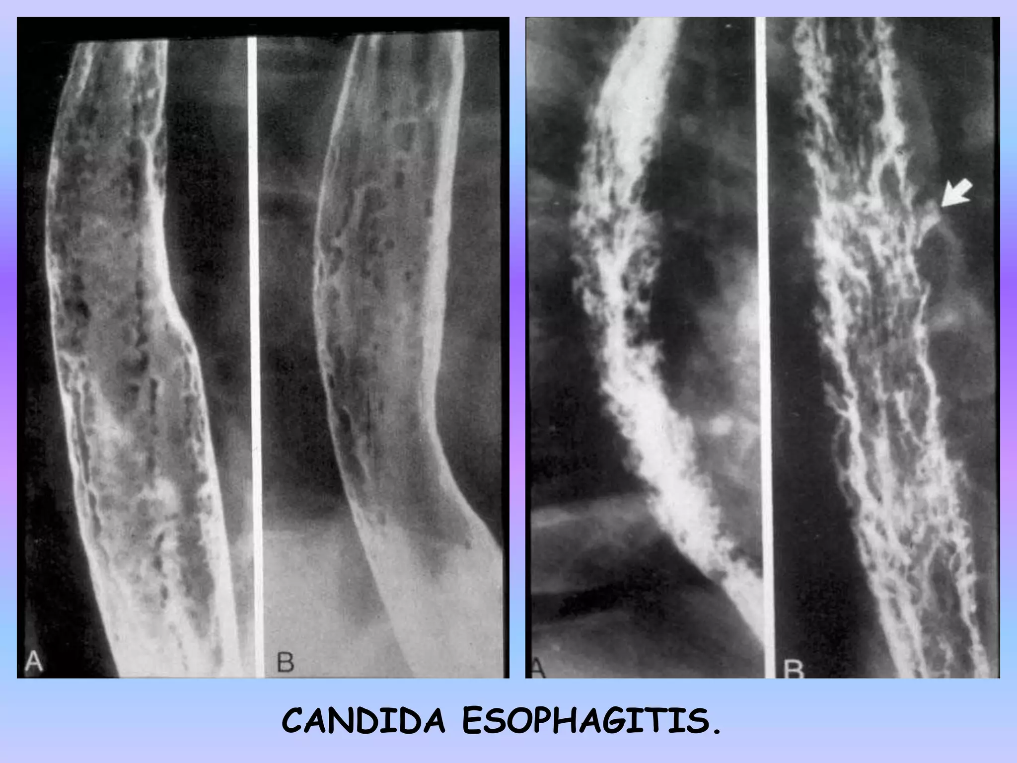 Presentation1.pptx, radiological imaging of esophageal lesions. | PPTX