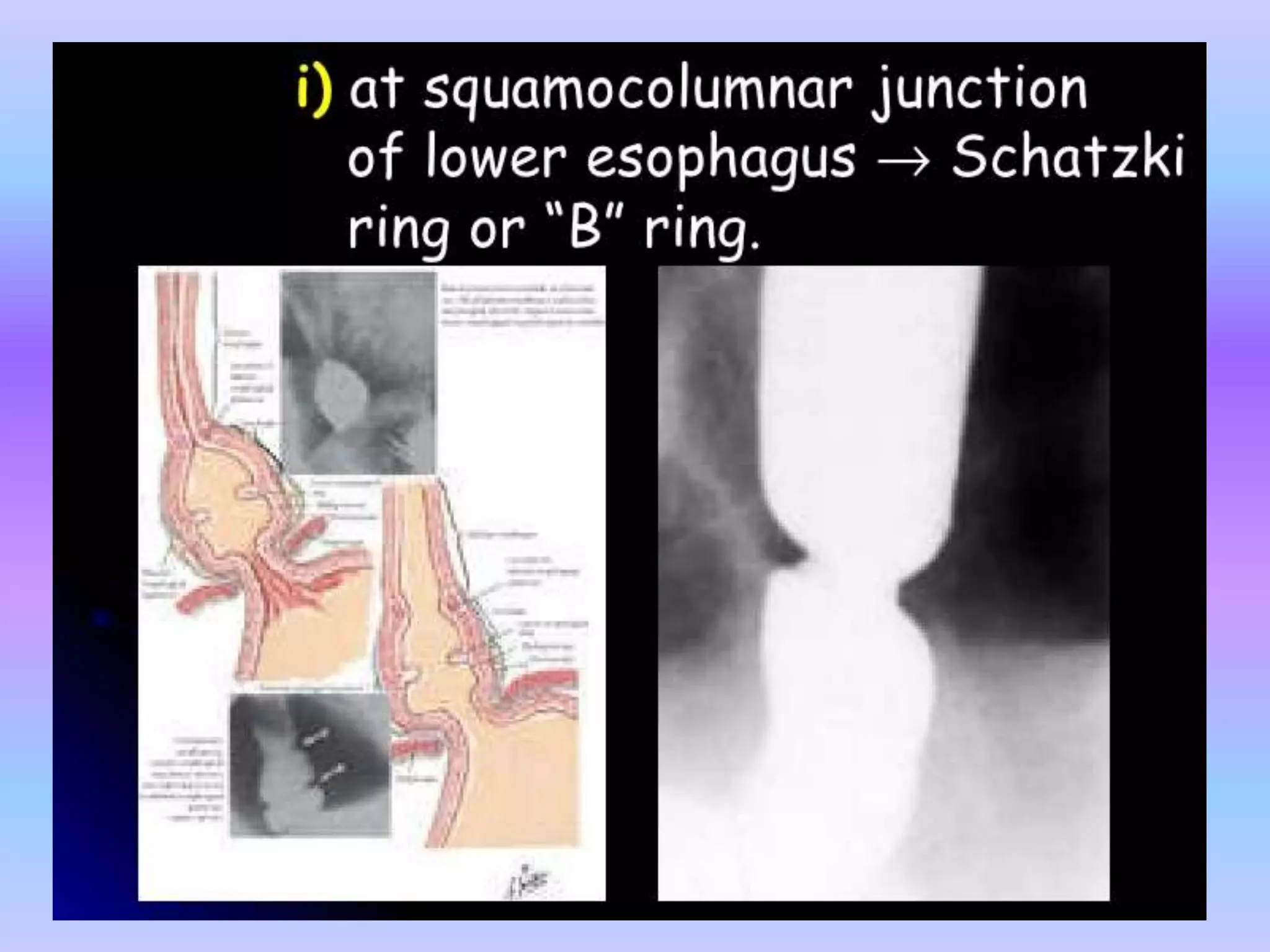Presentation1.pptx, radiological imaging of esophageal lesions. | PPTX