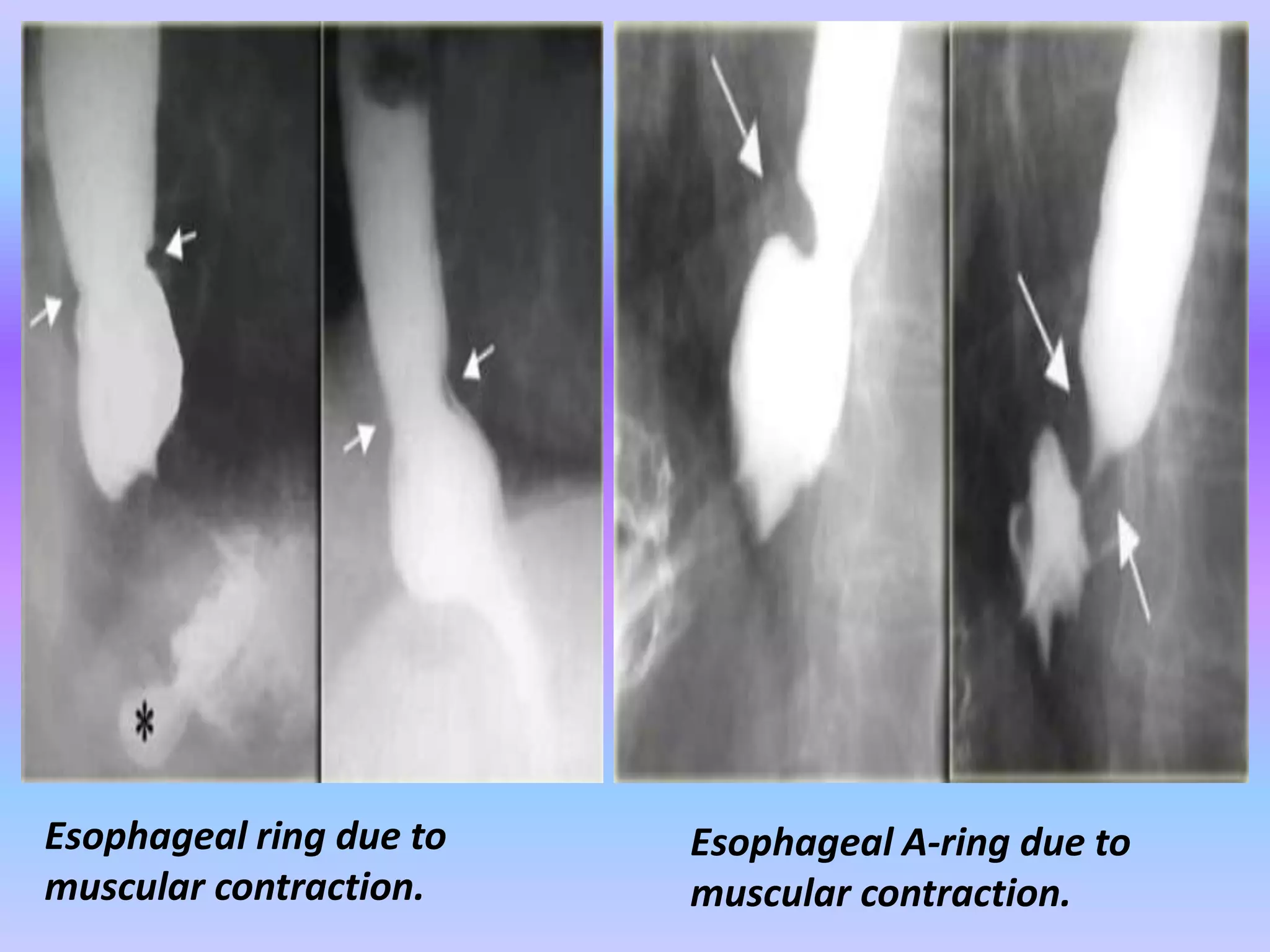 Presentation1.pptx, radiological imaging of esophageal lesions. | PPTX