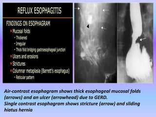 Abnormal Esophagram Boerhaave