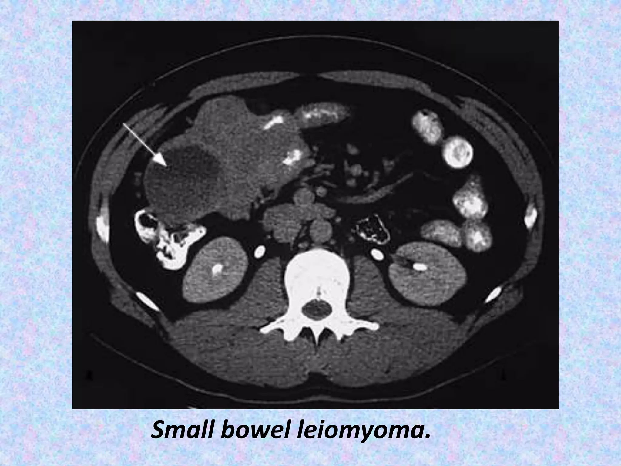 Presentation1.pptx, radiological imaging of small bowel disease. | PPTX