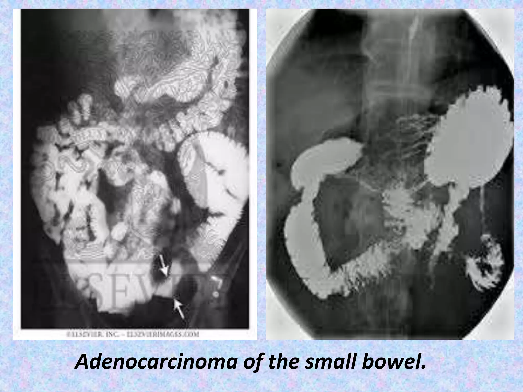 Presentation1.pptx, radiological imaging of small bowel disease. | PPTX