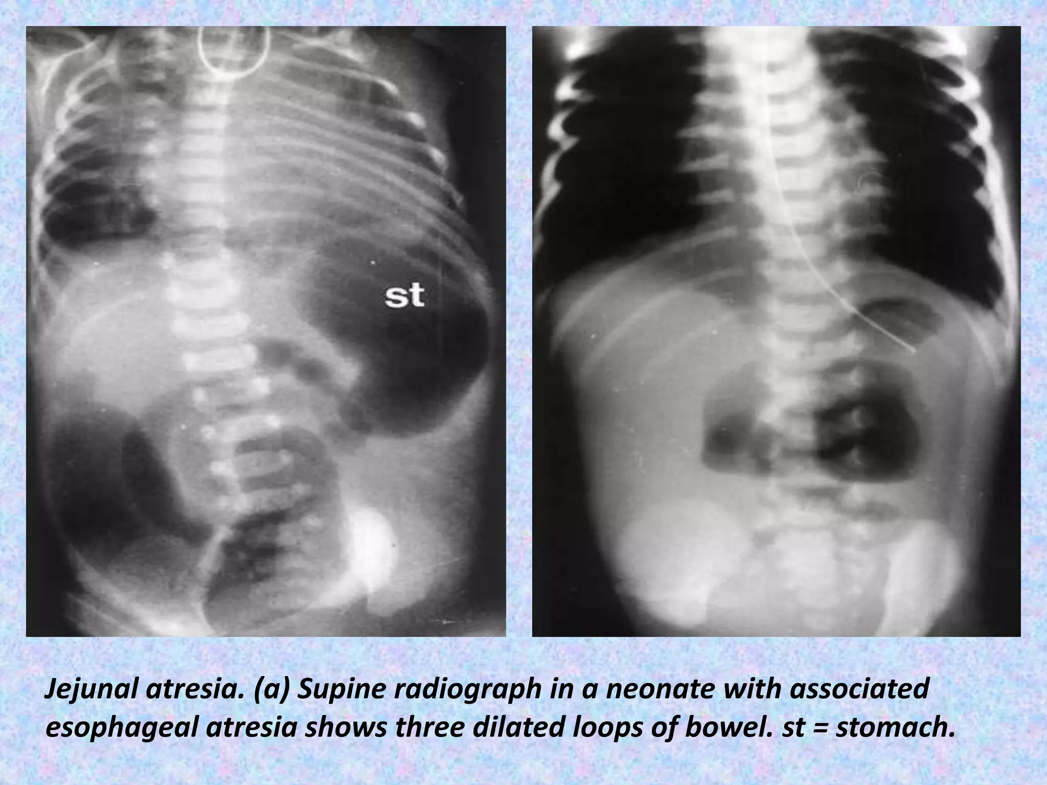 Presentation1.pptx, radiological imaging of small bowel disease. | PPTX