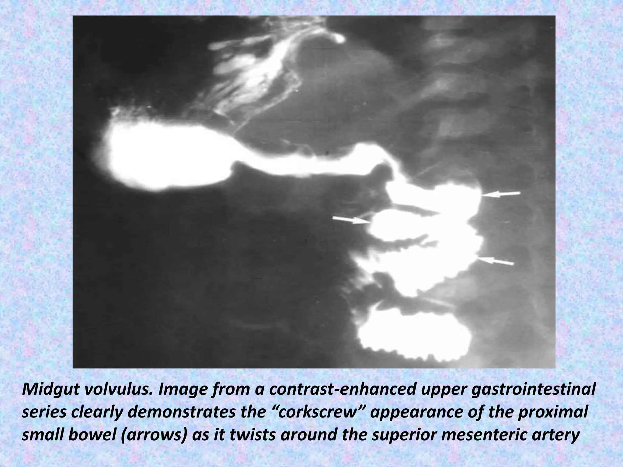 Presentation1.pptx, radiological imaging of small bowel disease. | PPTX
