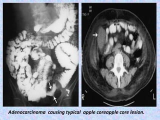 Presentation1.pptx, radiological imaging of small bowel disease. | PPTX