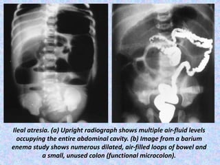 Presentation1.pptx, radiological imaging of small bowel disease. | PPTX