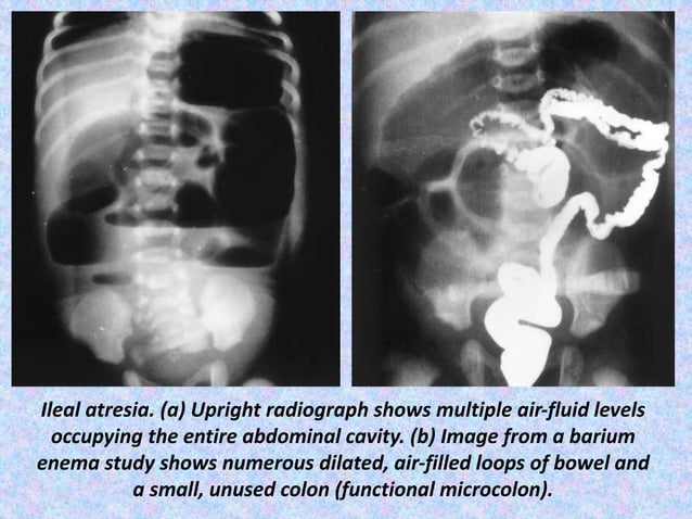 Presentation1.pptx, radiological imaging of small bowel disease. | PPTX