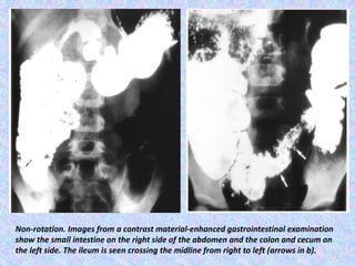 Presentation1.pptx, radiological imaging of small bowel disease. | PPTX