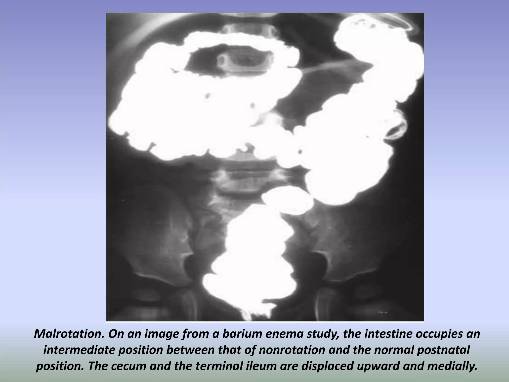 Presentation1.pptx, radiological imaging of large bowel diseases | PPTX