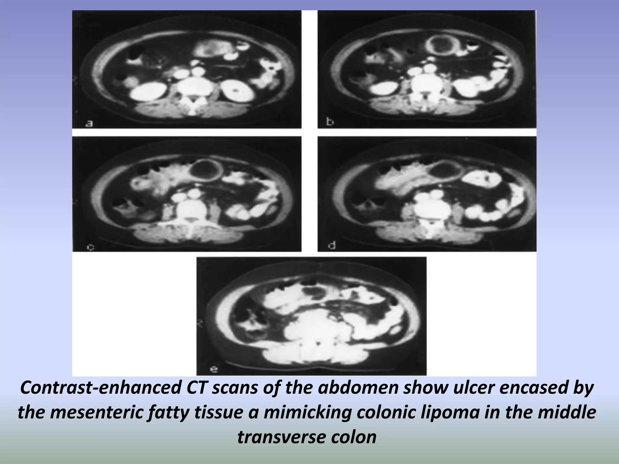 Presentation1.pptx, radiological imaging of large bowel diseases | PPTX