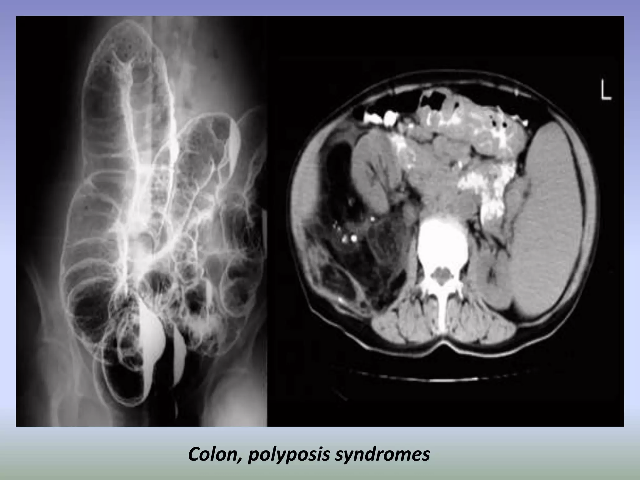 Presentation1.pptx, radiological imaging of large bowel diseases | PPTX