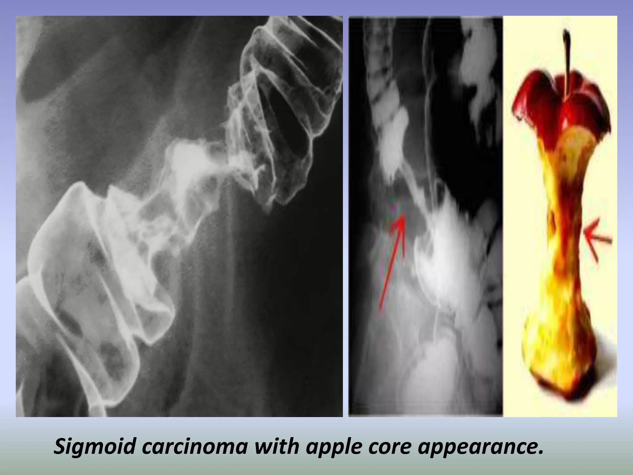 Presentation1.pptx, radiological imaging of large bowel diseases | PPTX