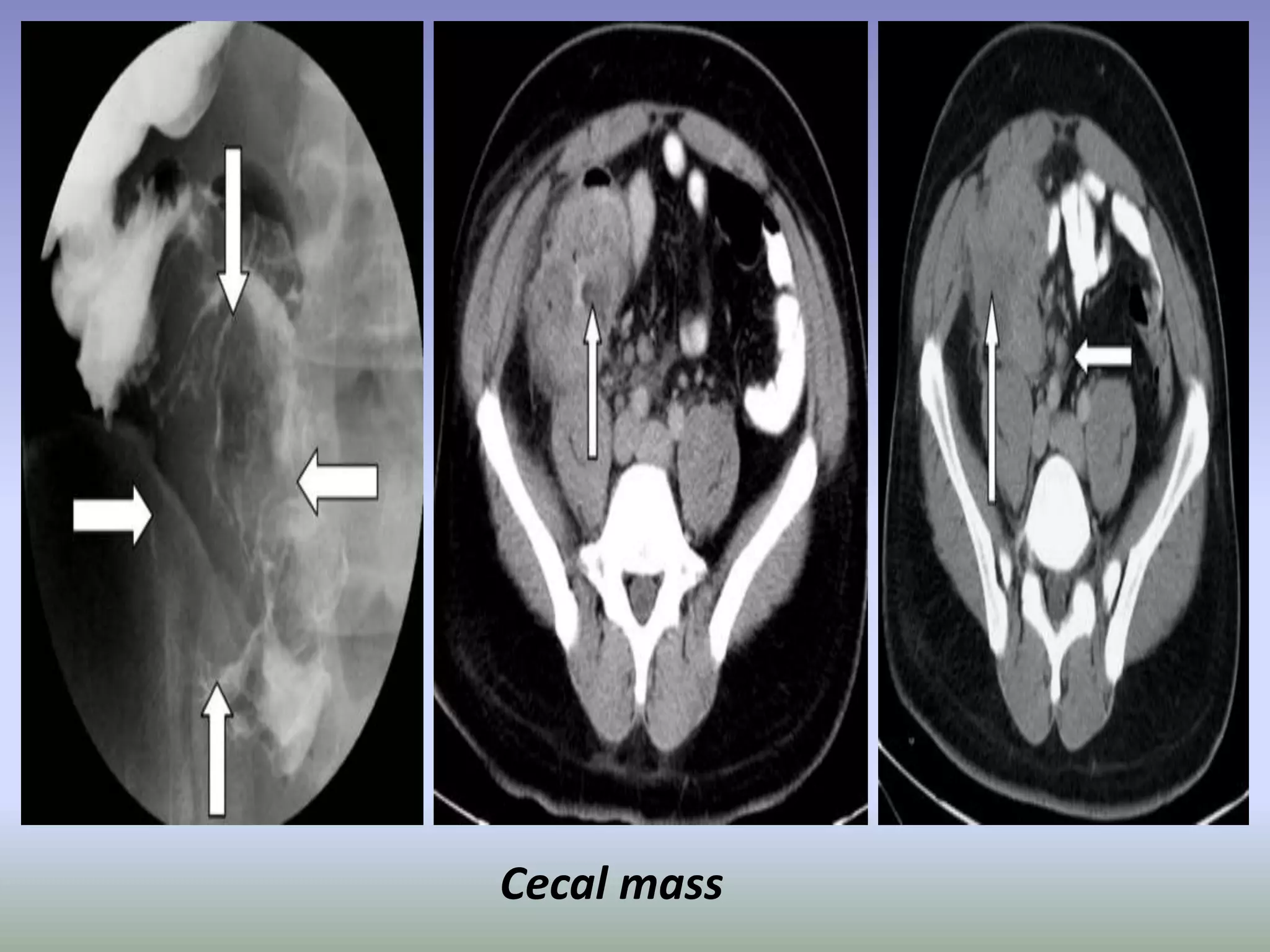 Presentation1.pptx, radiological imaging of large bowel diseases | PPTX ...