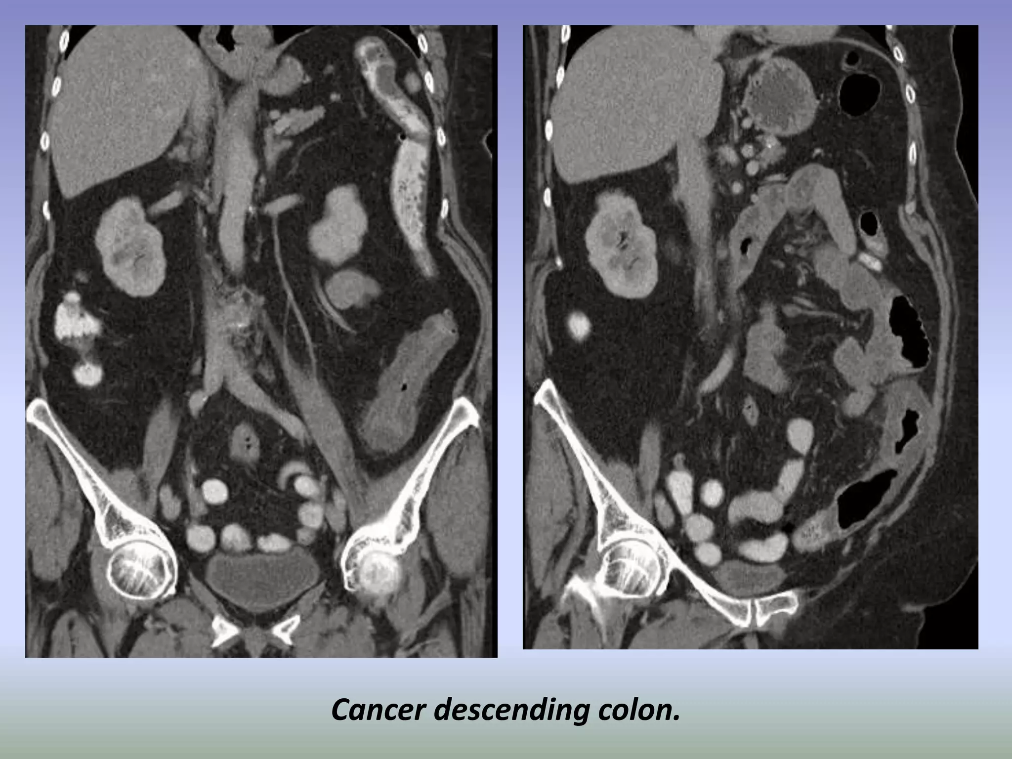 Presentation1.pptx, radiological imaging of large bowel diseases | PPTX