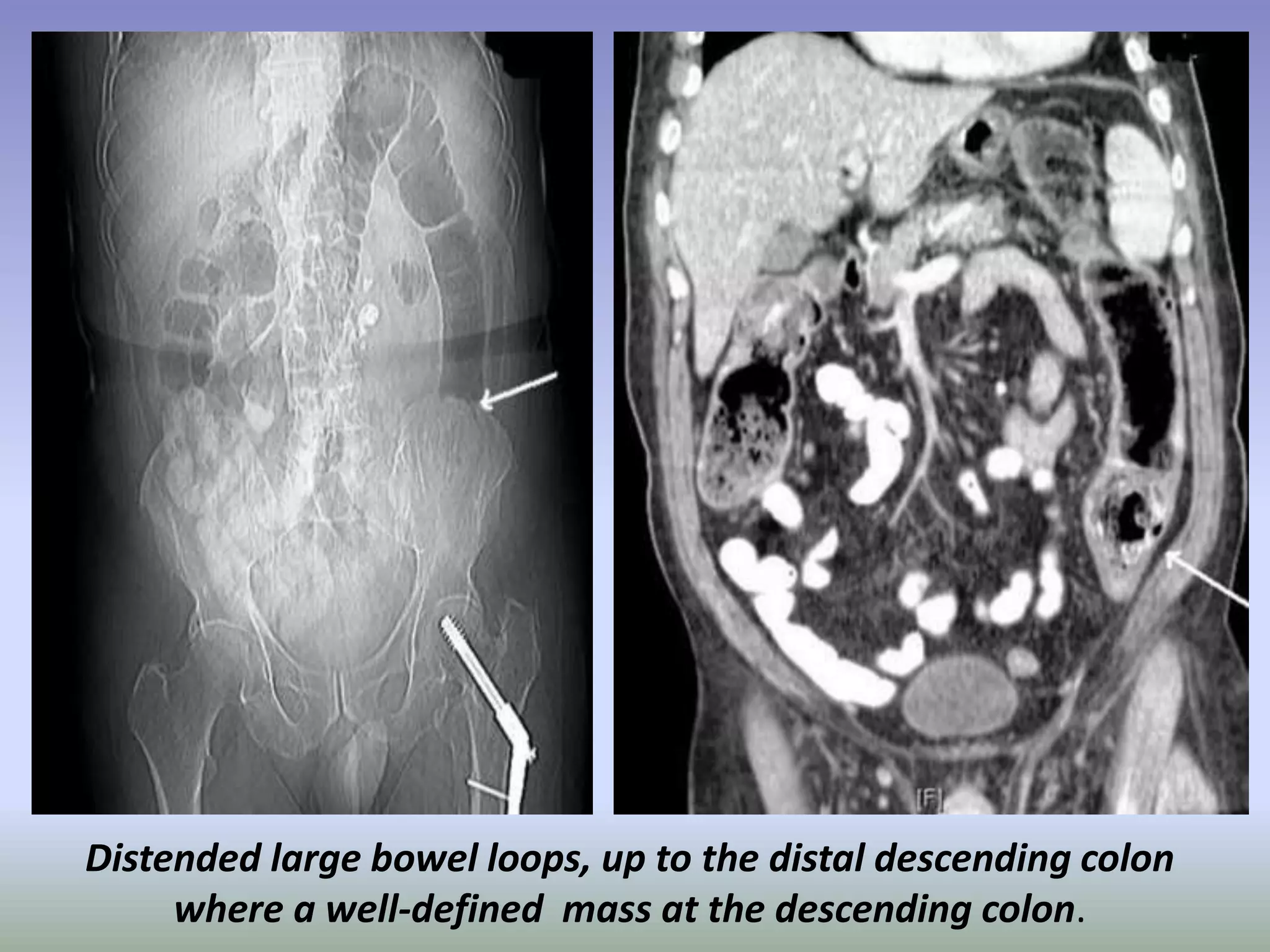 Presentation1.pptx, radiological imaging of large bowel diseases | PPTX