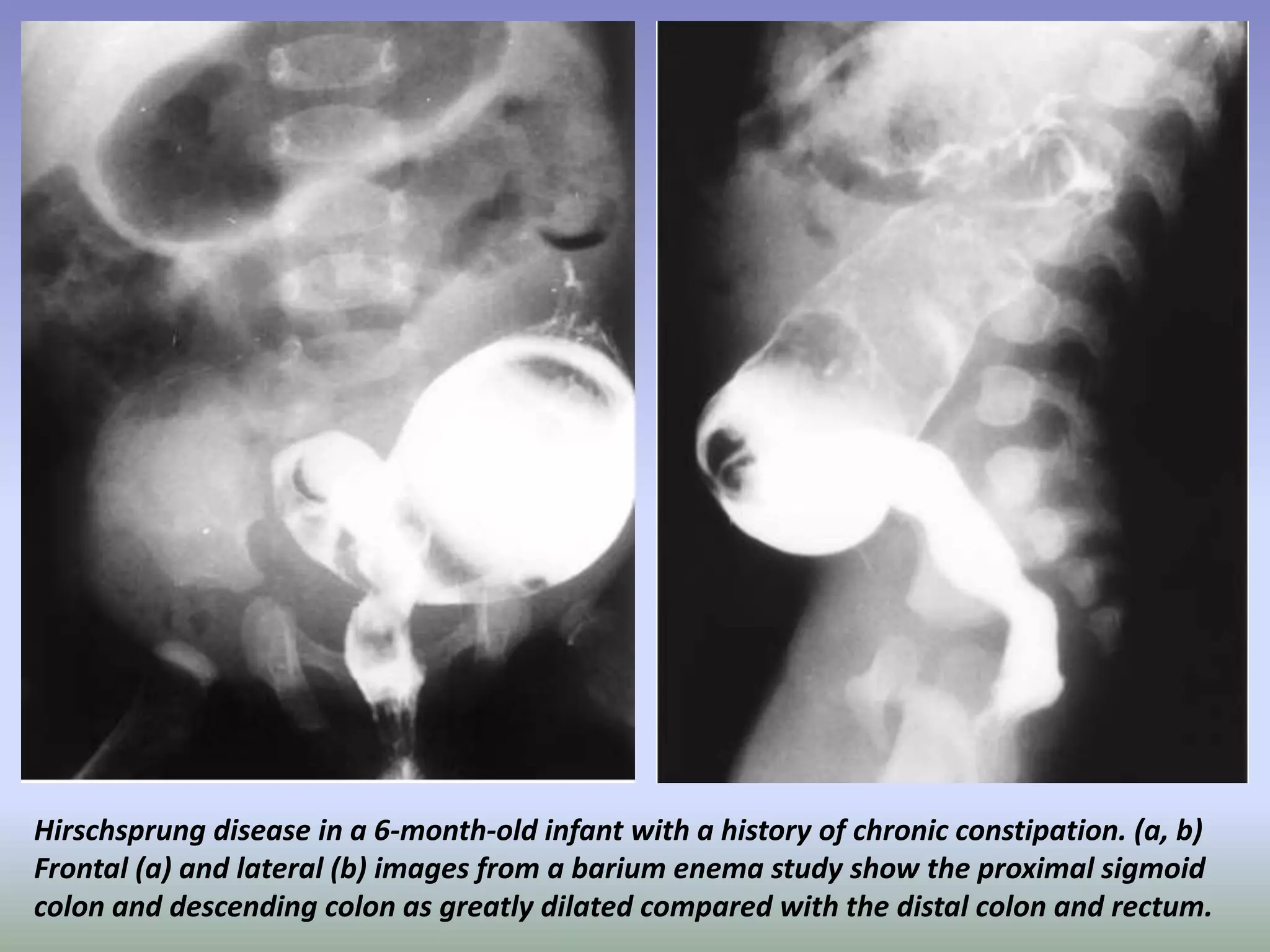 Presentation1.pptx, radiological imaging of large bowel diseases | PPTX