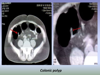 Presentation1.pptx, radiological imaging of large bowel diseases | PPTX