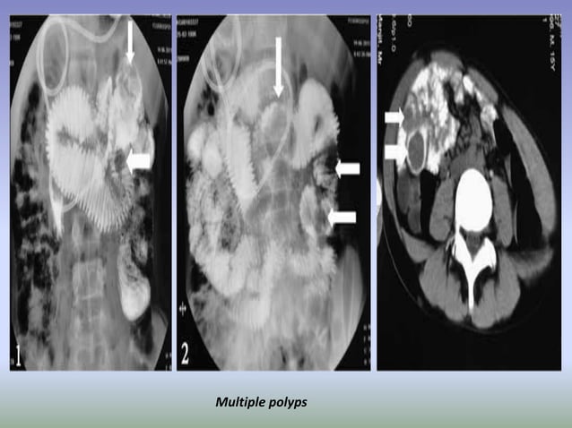 Presentation1.pptx, radiological imaging of large bowel diseases | PPTX ...