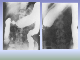 Presentation1.pptx, radiological imaging of large bowel diseases | PPTX