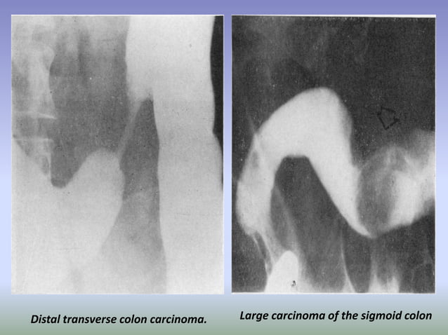 Presentation1.pptx, radiological imaging of large bowel diseases | PPTX ...